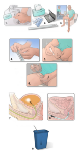 Step-by-Step Male Self Catheterization | Numotion
